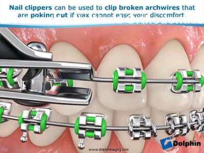 Care for Braces | Hartland Orthodontics